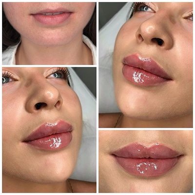 Revolax hyaluronic acid filler pen hyaluronic acid dermal filler serum