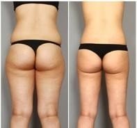 Fat Burning Machine with Cryolipolysis System body slimming machine price for sale