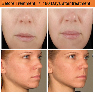 Hifu Face lifting Beauty mahcine/HIFU Machine/ HIFU Face Lift with Lowest Price / high int