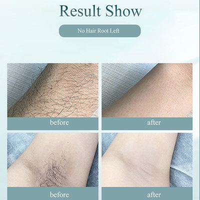 Portable 2020 Ipl Permanent Portable Mini Hair Removal Machine Laser Hair Remover At Home supplier