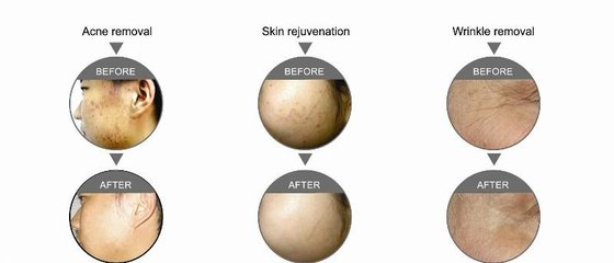 Female Face Lifting Skin Rejuvenation Equipment PDT With Touch Screen