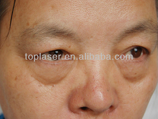 IPL Multifunction Beauty Equipment Professional For Skin Lifting