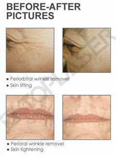 Powerful IPL Energy Output Multifunction Beauty Equipment Skin Rejuvenation