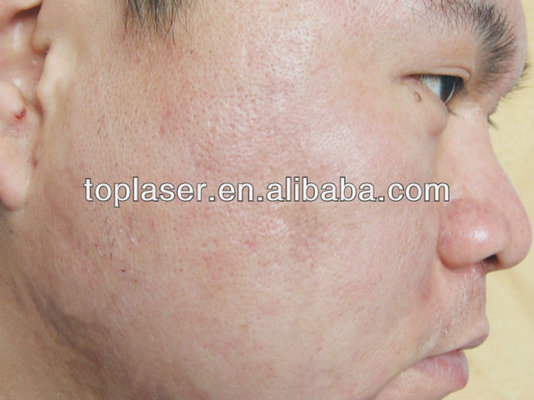 Stationary PDT Skin Rejuvenation LED Theraphy Device Acne Fine Lines Treatment