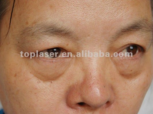 Home PDT Skin Rejuvenation 1500 Led lights Spots Improvement Touch Screen