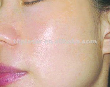 IPL Skin Rejuvenation Equipment E-light RF Skin Care Machine For Women