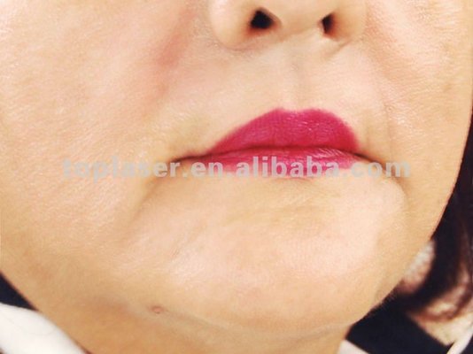 Portable Cavitation And Radiofrequency Machine For Body Slimming