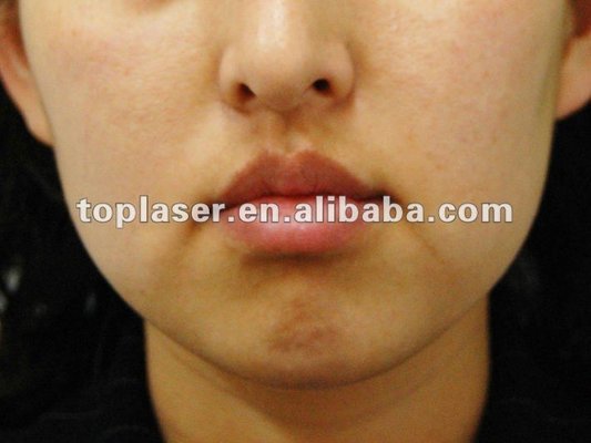 Erbium Glass Fractional Laser, 1550nm Fractional/Aging Spots/Wrinkles Removal