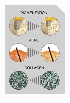 Portable PDT Skin Rejuvenation
