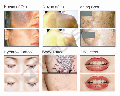 10.4 Inch 1064nm TOP HAT 532nm Nd Yag Q Switched Laser Tattoo Melasma Removal
