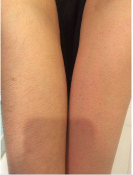 Vertical Laser Hair Removal Machine , Laser Removal Machine Micro Channel Cooling