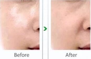 Skin Rejuvenation Oxygen Skin Treatment Machine With 500mm Jet Distance